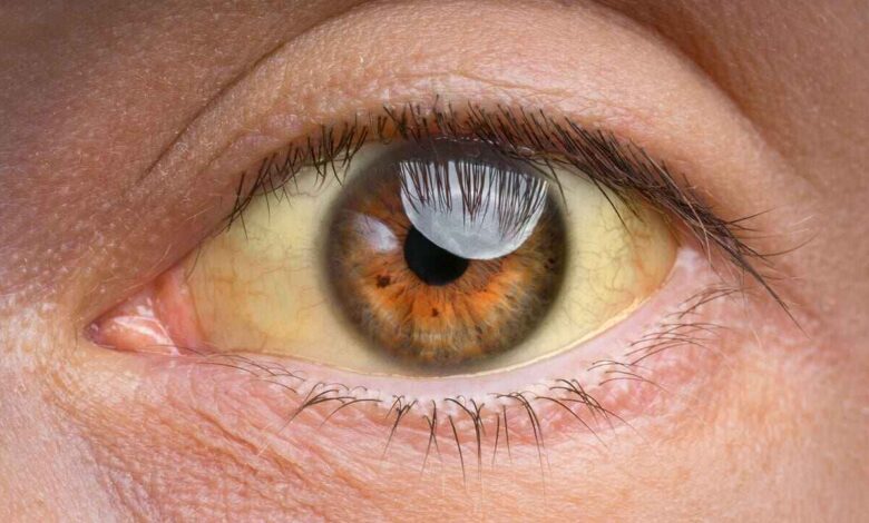 Yellowing Eyes May Signal Serious Liver Trouble Experts Urge Early ...